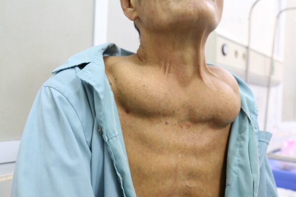 Bệnh Madelung: Triệu chứng, nguyên nhân và cách điều trị.